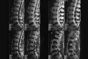 The problem with MRIs for low back pain - Salon.com
